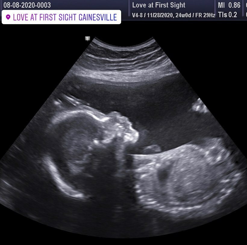 Ultrasound Packages - 3D/4D HD Elective Ultrasound - Gainesville, TX